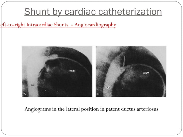 Assessment of shunt by cardiac catheterization | PPT | Heart and ...