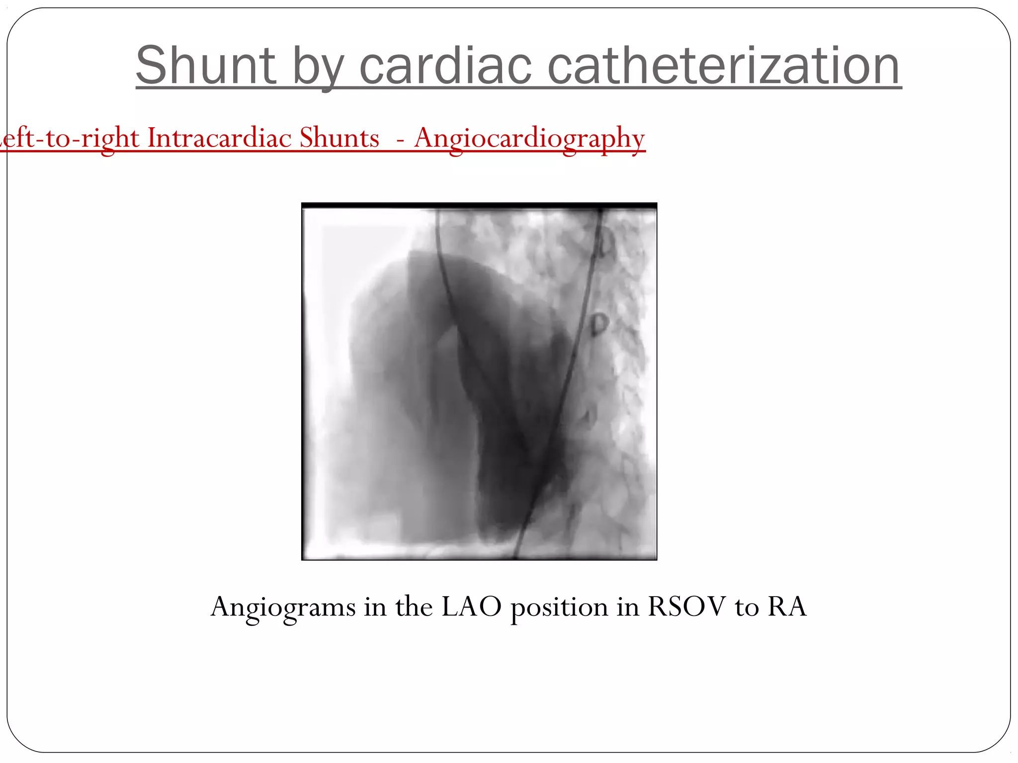 Assessment of shunt by cardiac catheterization | PPT