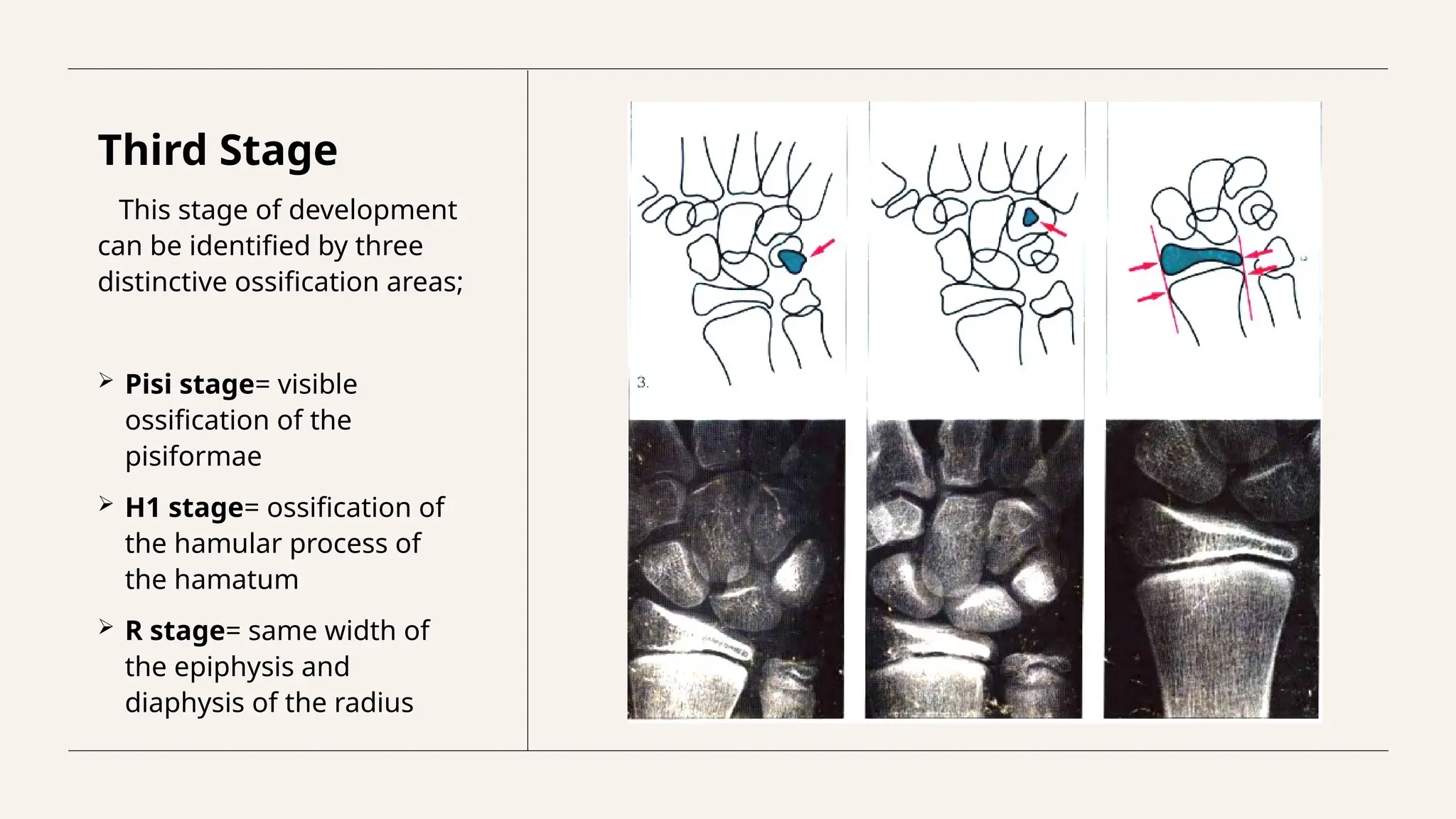 Assessment of skeletal age in Orthodontics | PPTX
