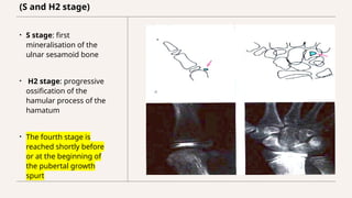 Assessment of skeletal age in Orthodontics | PPTX