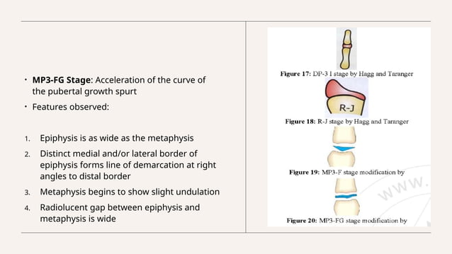 Assessment of skeletal age in Orthodontics | PPTX