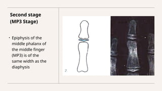 Assessment of skeletal age in Orthodontics | PPTX