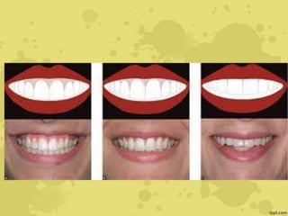 Assessment of smile | PPTX