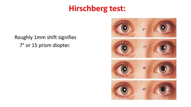 Assessment of strabismus | PDF | Eye and Vision Conditions | Diseases ...