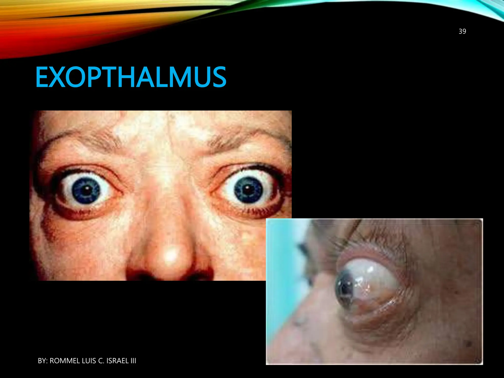ASSESSMENT OF THE EYE (1)-Health Assessment.ppt