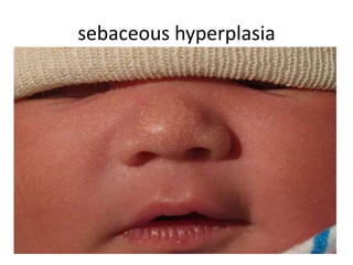 Sebaceous Hyperplasia Newborn