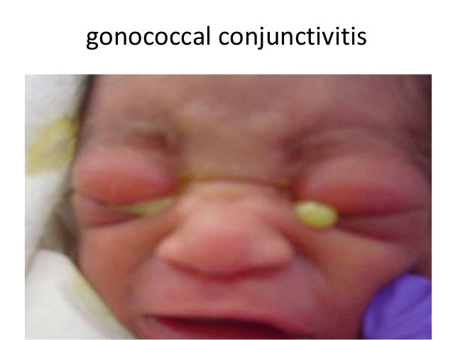 Neonatal Gonococcal Ophthalmia