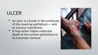 ASSESSMENT OF ULCER - in Clinical Surgery.pptx