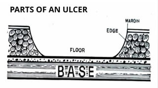 ASSESSMENT OF ULCER - in Clinical Surgery.pptx