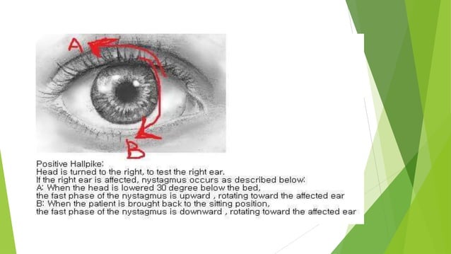 Assessment of vestibular system | PPTX