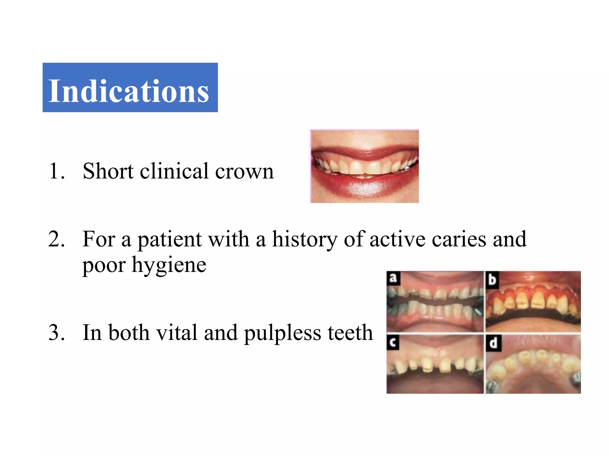Retainer in FPD | PPTX