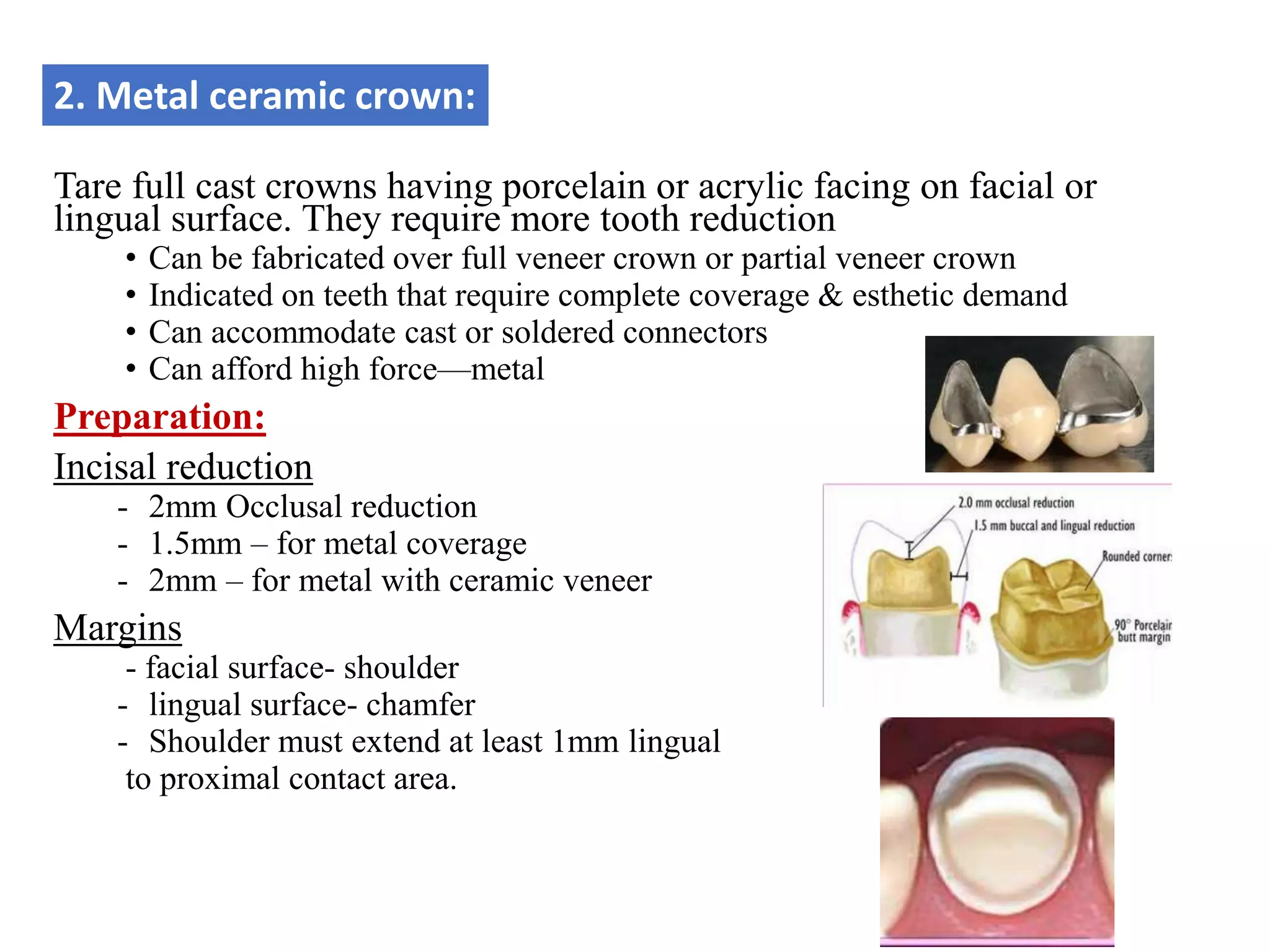 Retainer in FPD | PPTX