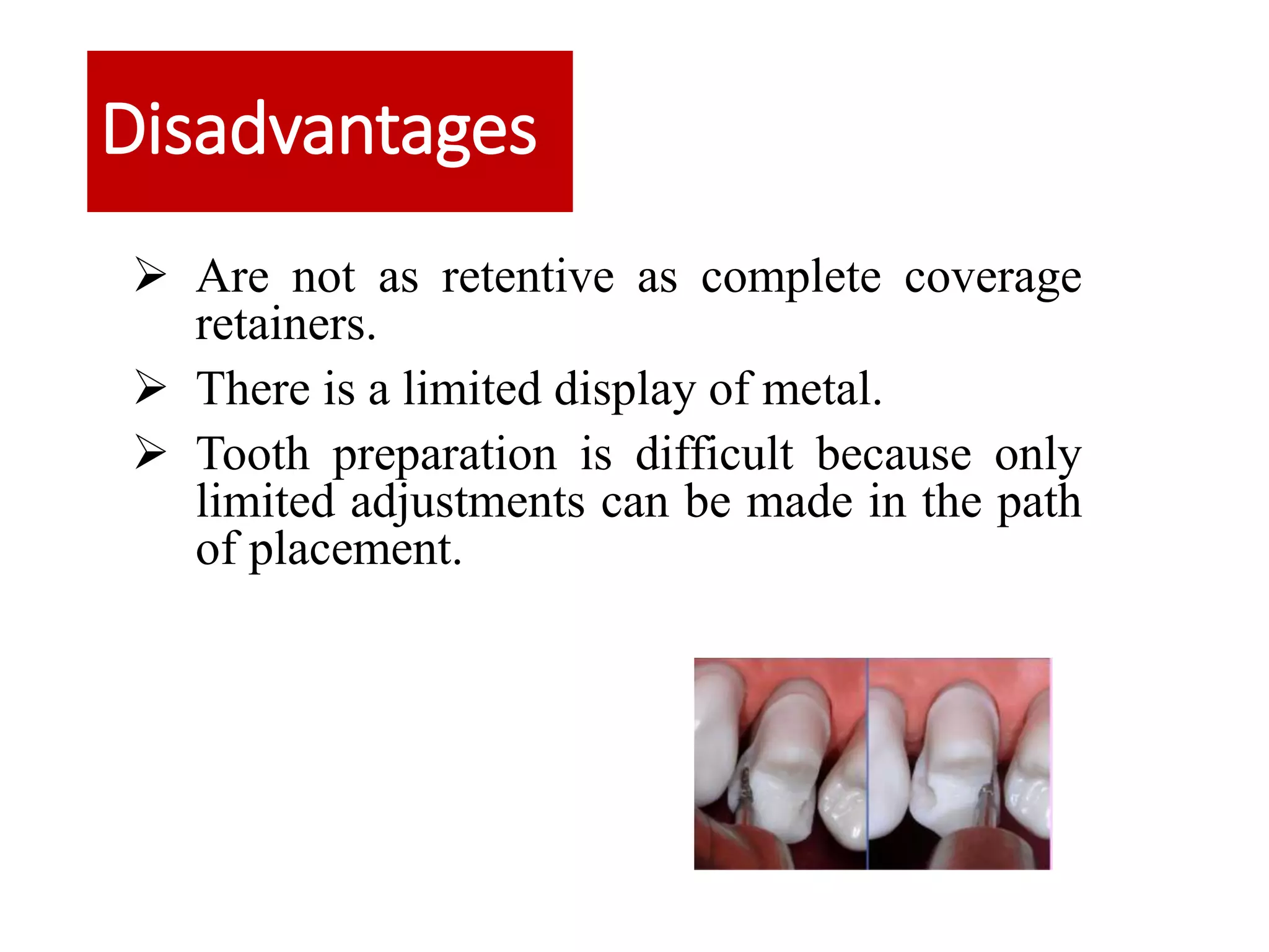 Retainer in FPD | PPTX
