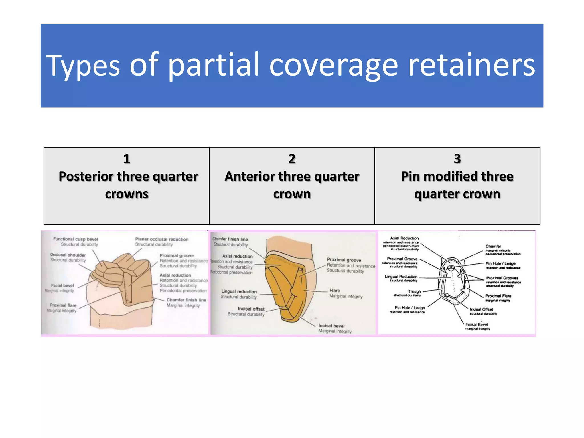 Retainer in FPD | PPTX