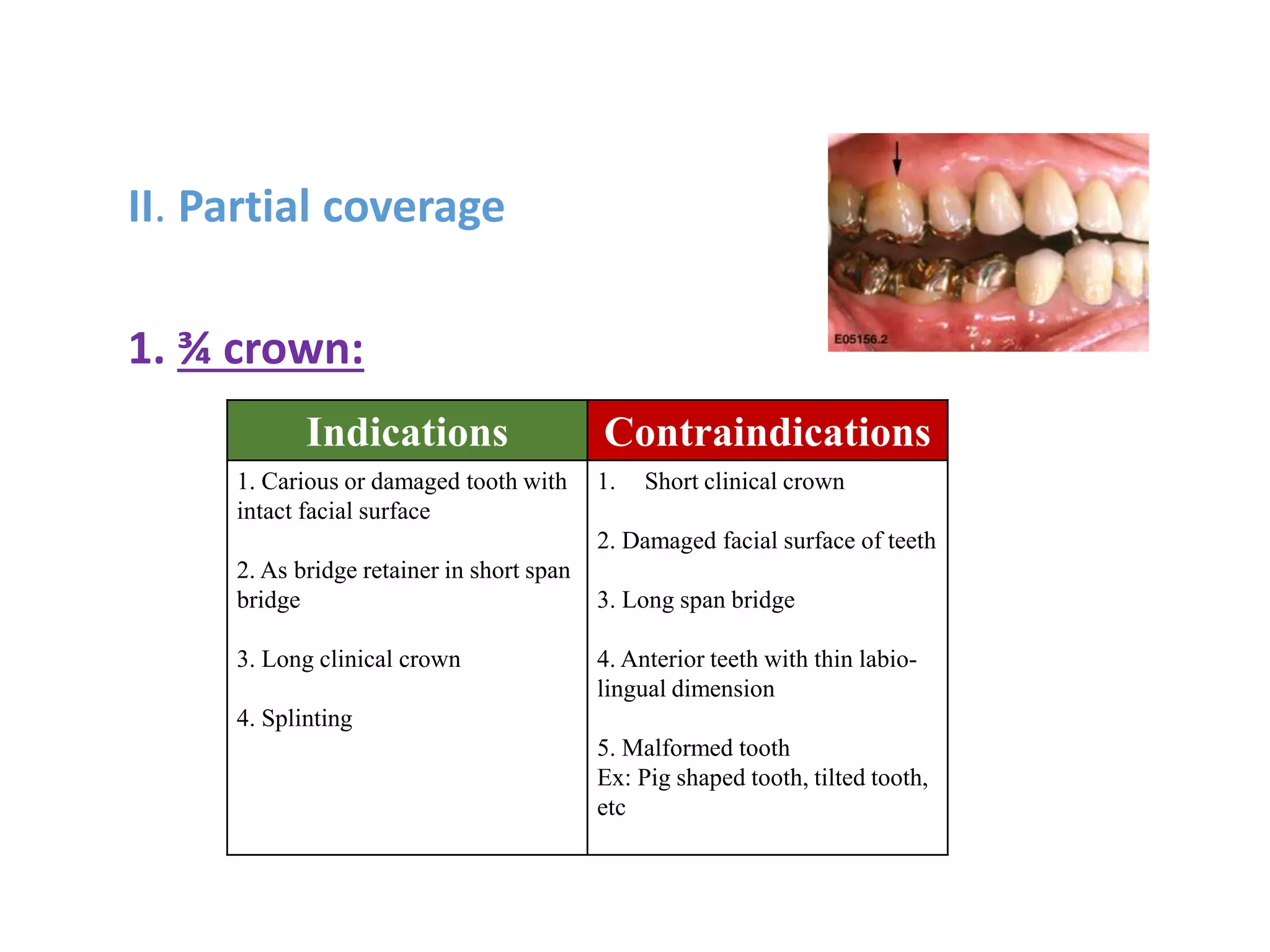 Retainer in FPD | PPTX