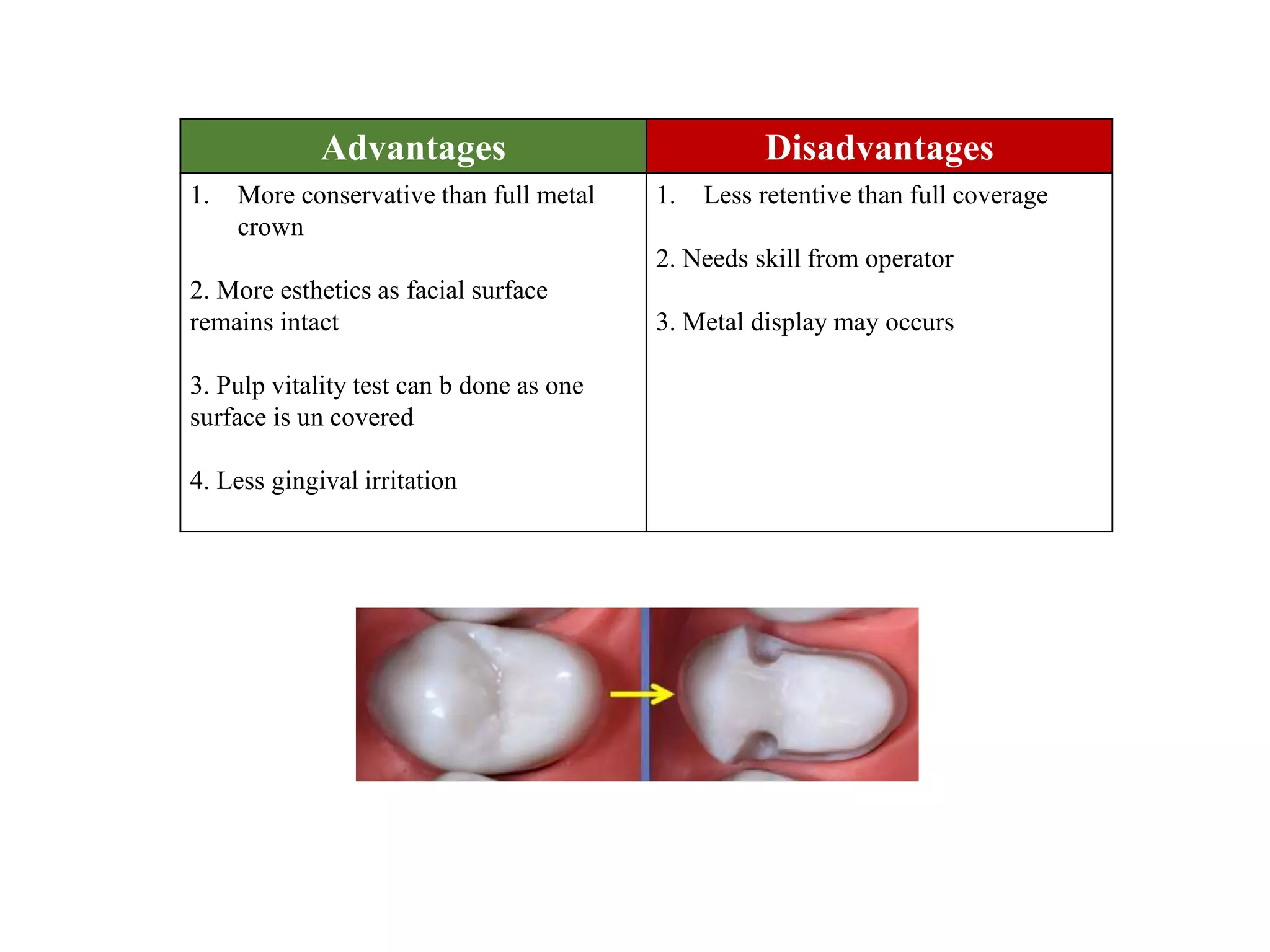 Retainer in FPD | PPTX