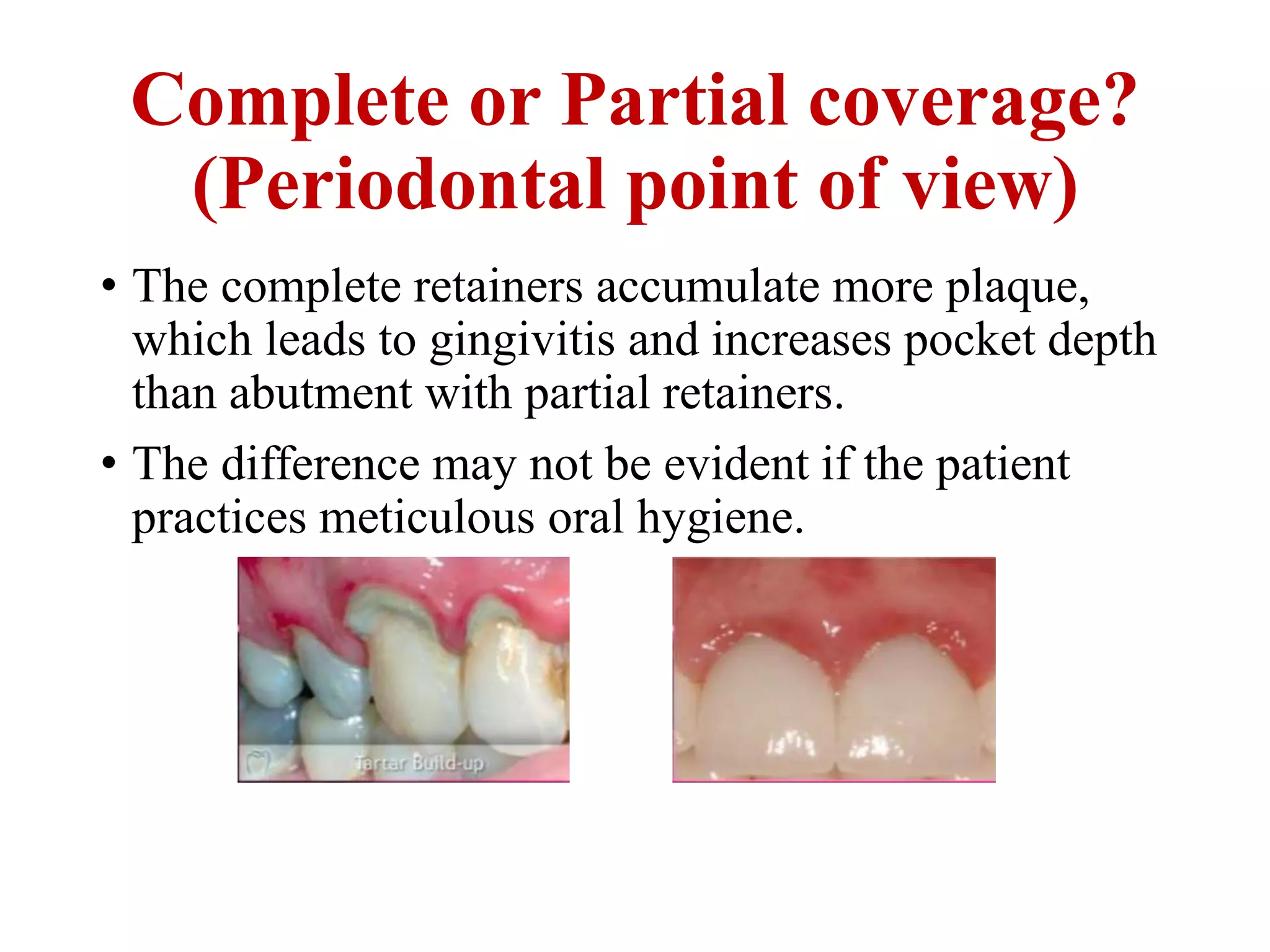 Retainer in FPD | PPTX