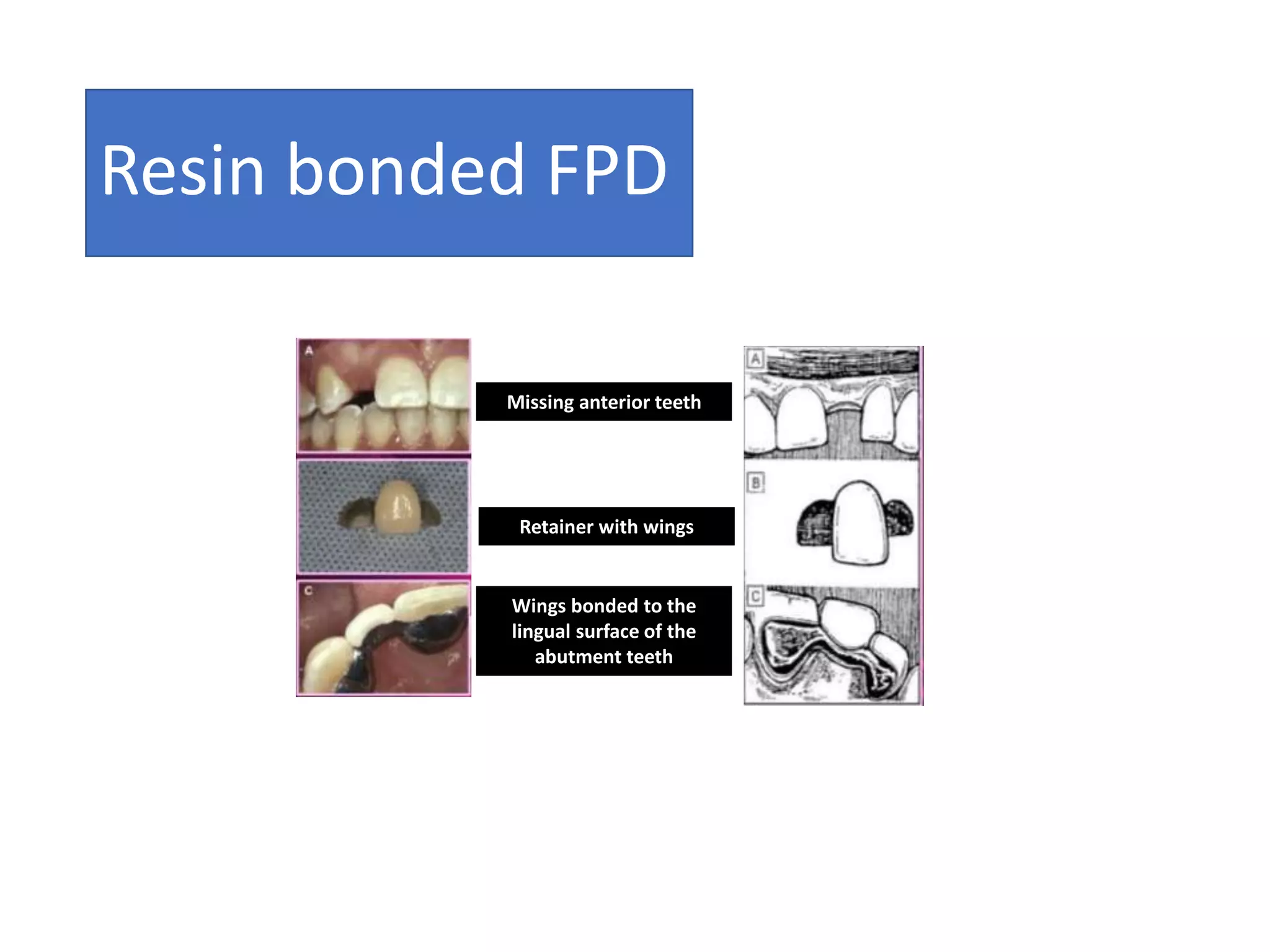 Retainer in FPD | PPTX | Oral care | Personal Care