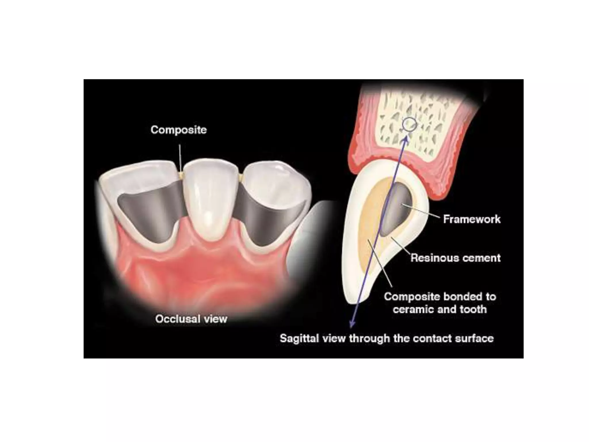Retainer in FPD | PPTX