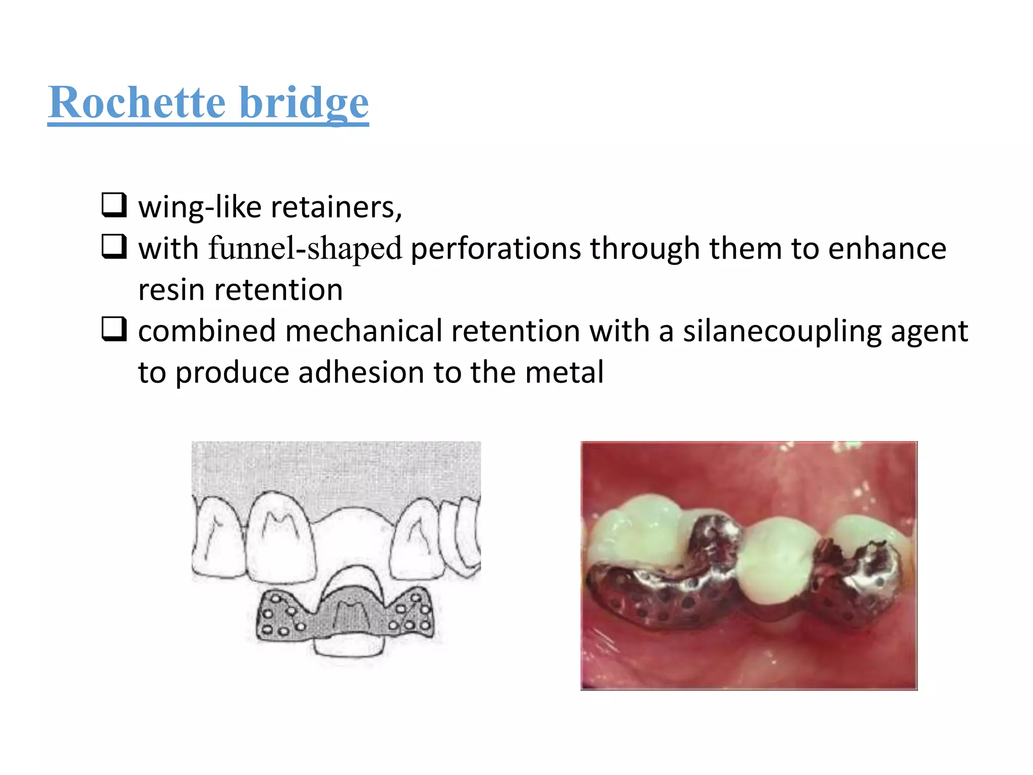 Retainer in FPD | PPTX | Oral care | Personal Care
