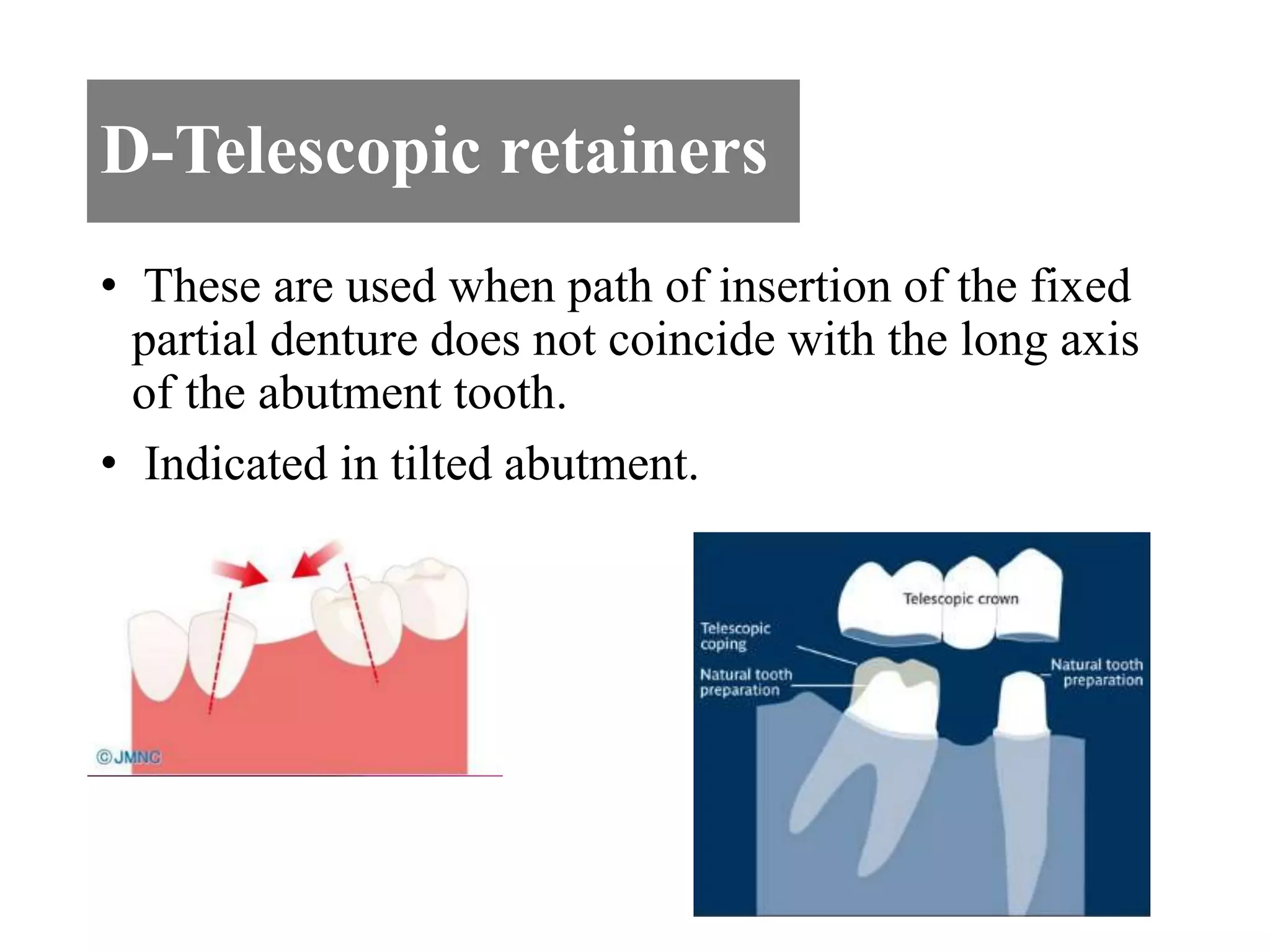 Retainer in FPD | PPTX