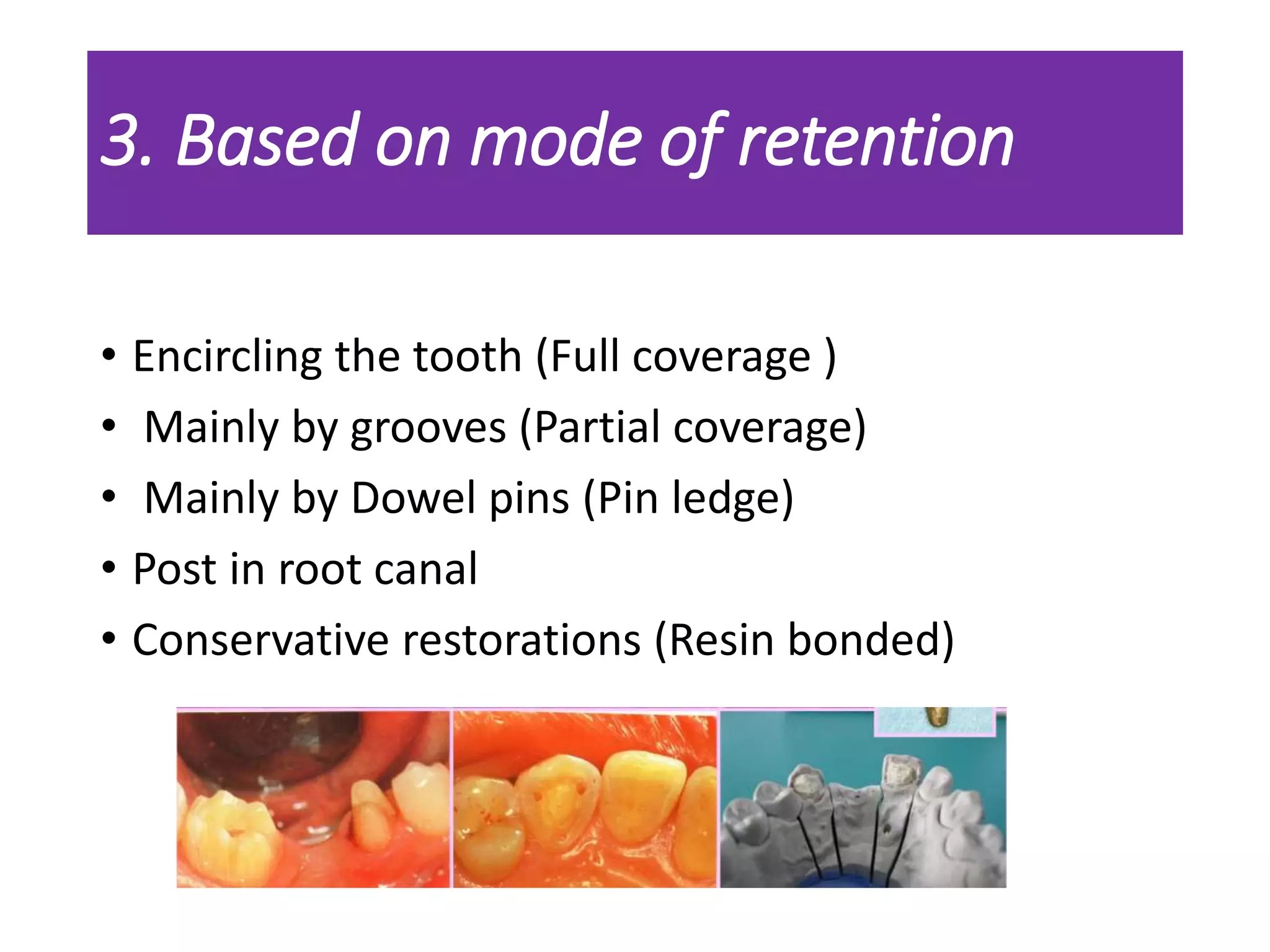 Retainer in FPD | PPTX