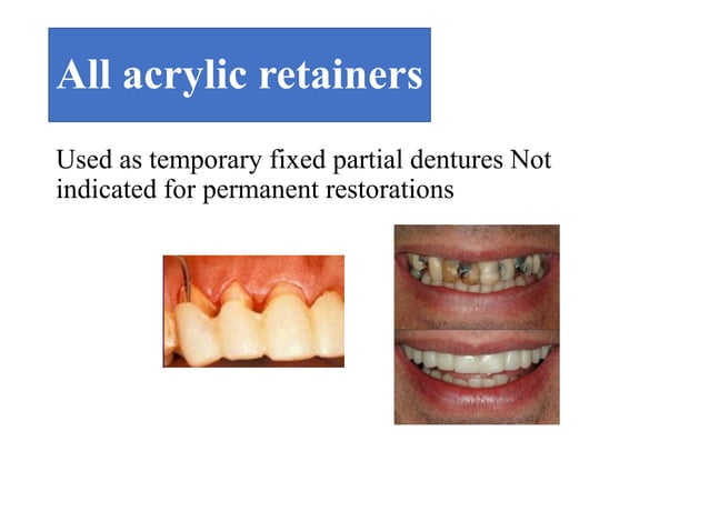 Retainer in FPD | PPTX | Oral care | Personal Care
