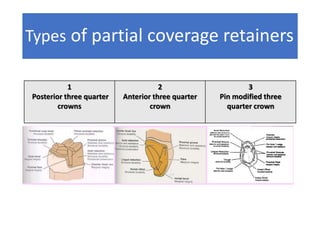 Retainer in FPD | PPTX