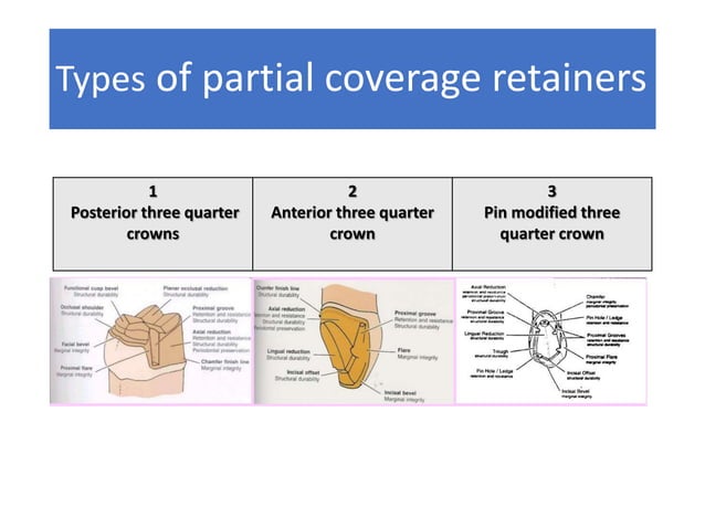 Retainer in FPD | PPTX | Oral care | Personal Care