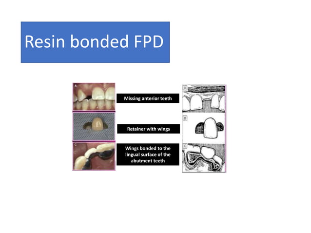 Retainer in FPD | PPTX | Oral care | Personal Care
