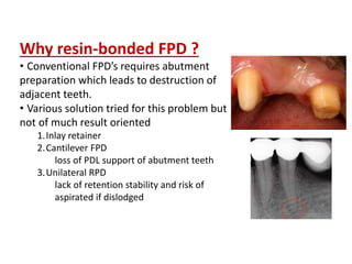 Retainer in FPD | PPTX