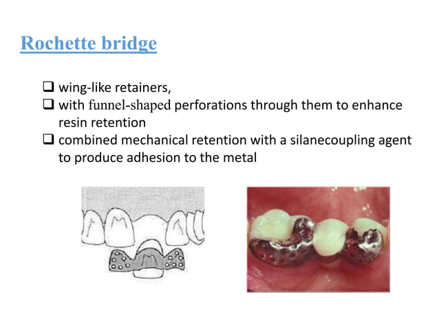 Retainer in FPD | PPTX | Oral care | Personal Care