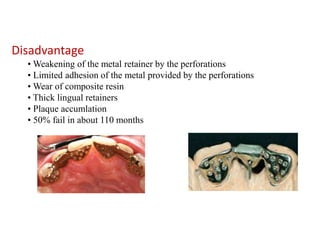 Retainer in FPD | PPTX