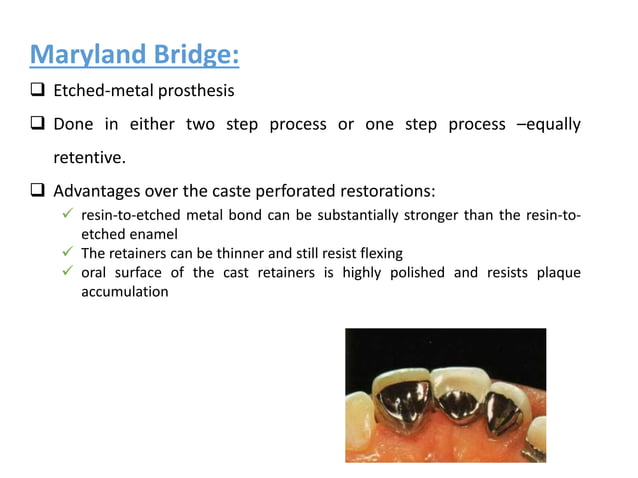 Retainer in FPD | PPTX | Oral care | Personal Care