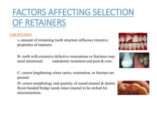 Retainer in FPD | PPTX