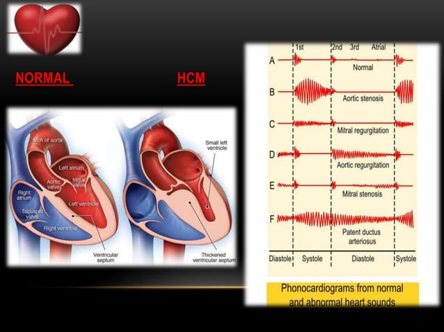 Heart Sounds and Murmurs | PPT