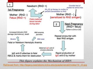 Hemolytic Disease of Newborn (HDN) | PPTX