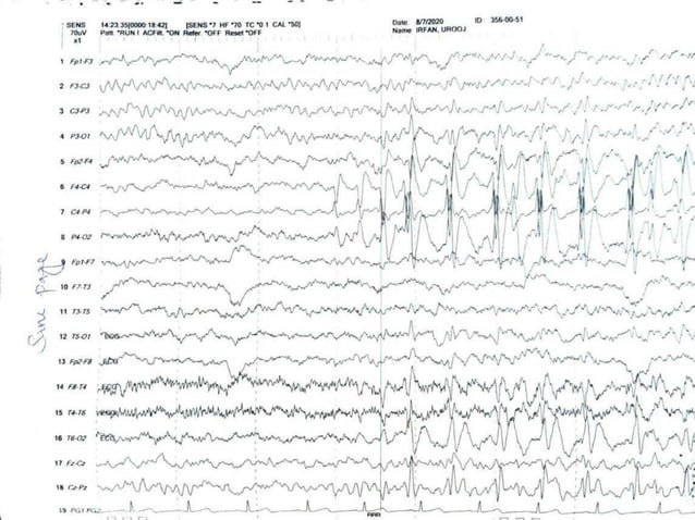 Abnormal EEG patterns | PPTX | Brain and Nervous System Disorders ...