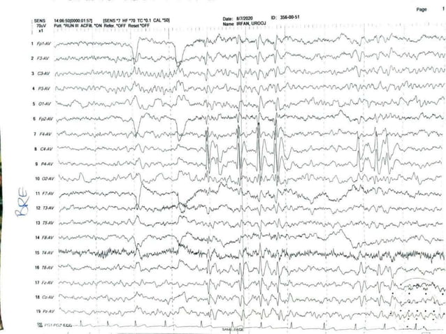 Abnormal EEG patterns | PPTX | Brain and Nervous System Disorders ...