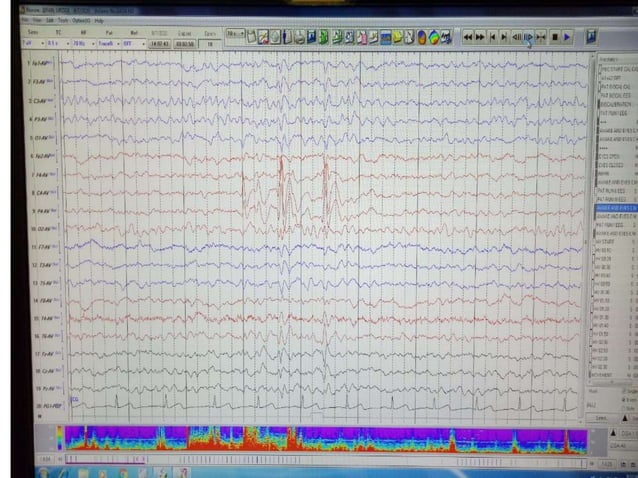 Abnormal EEG patterns | PPTX | Brain and Nervous System Disorders ...