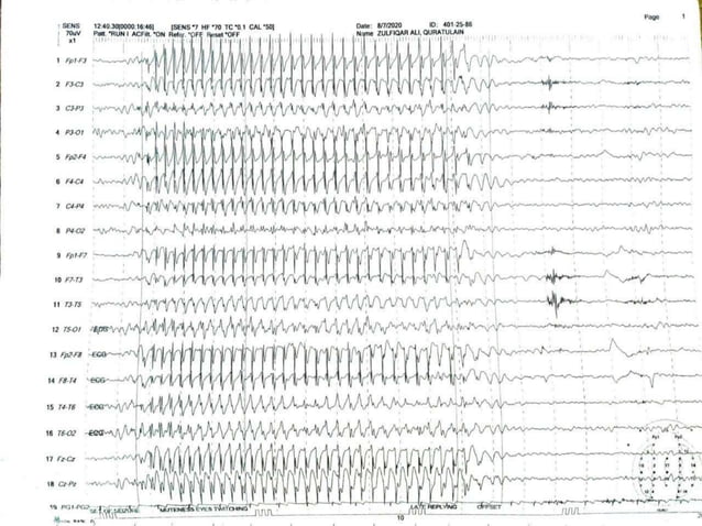 Abnormal EEG patterns | PPTX | Brain and Nervous System Disorders ...