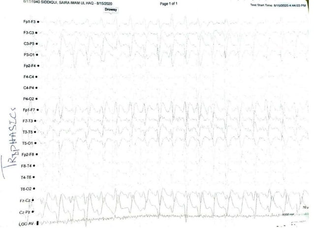 Abnormal EEG patterns | PPTX | Brain and Nervous System Disorders | Diseases and Conditions