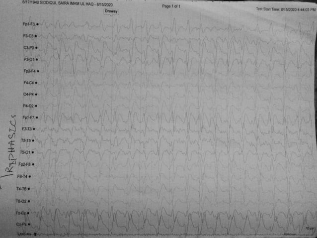 Abnormal EEG patterns | PPTX | Brain and Nervous System Disorders | Diseases and Conditions