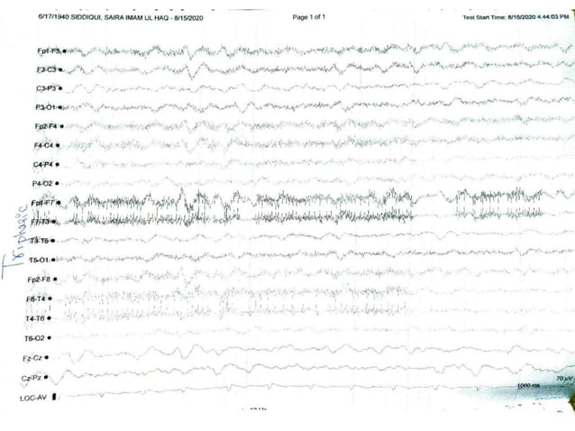 Abnormal EEG patterns | PPTX | Brain and Nervous System Disorders ...