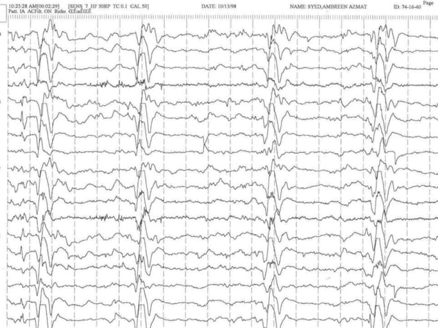 Abnormal EEG patterns | PPTX | Brain and Nervous System Disorders ...