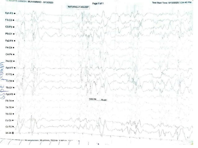 Abnormal EEG patterns | PPTX | Brain and Nervous System Disorders ...