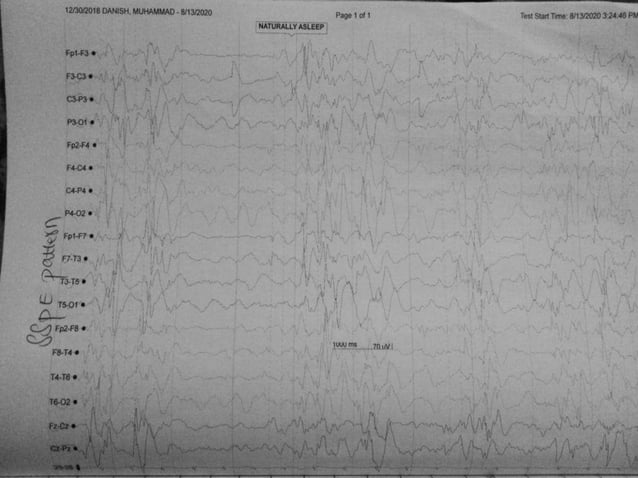Abnormal EEG patterns | PPTX | Brain and Nervous System Disorders ...