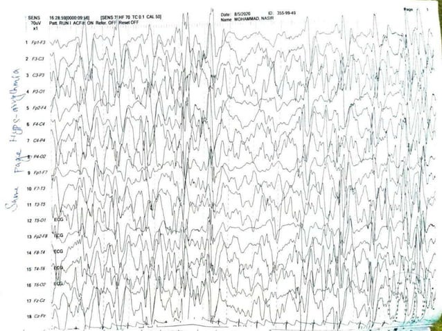 Abnormal EEG patterns | PPTX | Brain and Nervous System Disorders ...