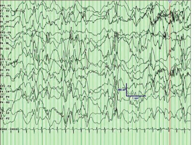 Abnormal EEG patterns | PPTX | Brain and Nervous System Disorders ...