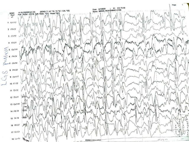 Abnormal EEG patterns | PPTX | Brain and Nervous System Disorders ...